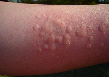 strawberry-allergy-symptoms - Child Allergy